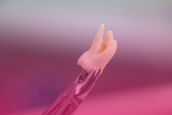 Turning Wisdom Teeth into a Breakthrough for CMT and HNPP Studies - CMTUK